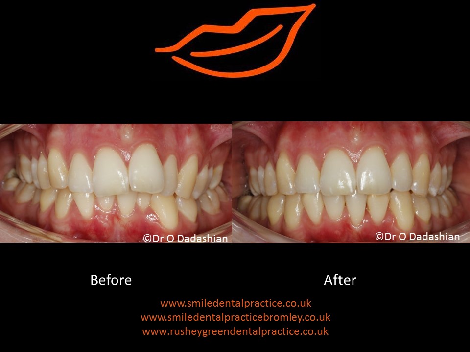 15 Facts About Invisalign SDP Bromley Blog